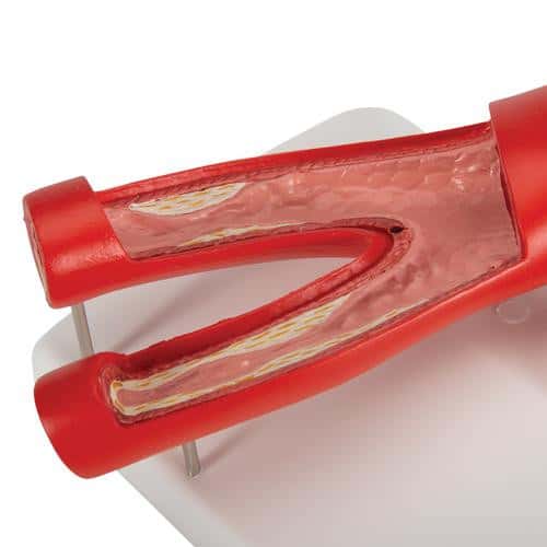 3B Scientific Arteriosclerosis Anatomy Model On Base | Anatomy Warehouse