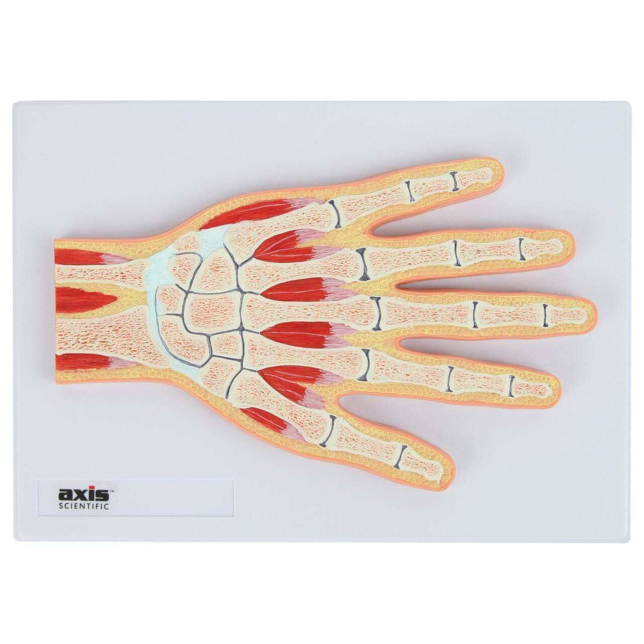 GPI Anatomicals Osteoarthritis Hand Anatomy Model | Anatomy Warehouse