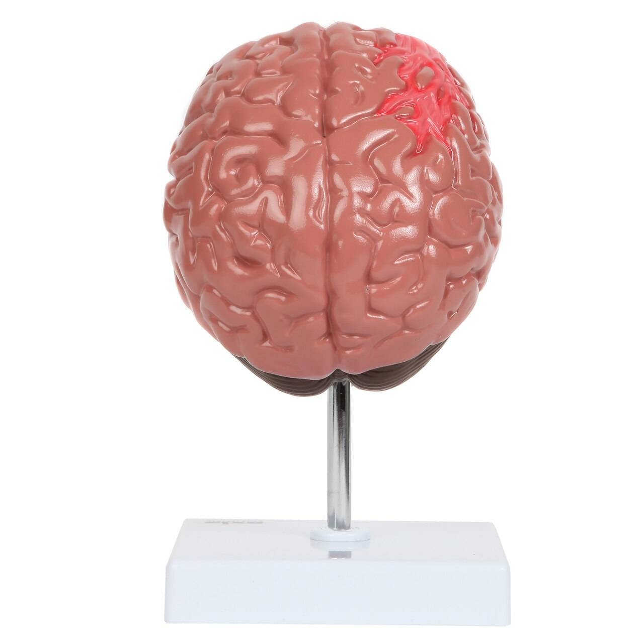 Axis Scientific Human Brain Anatomy Model with Pathologies | Anatomy ...