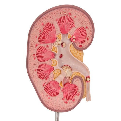 3B Scientific Kidney Stone Anatomy Model | Anatomy Warehouse