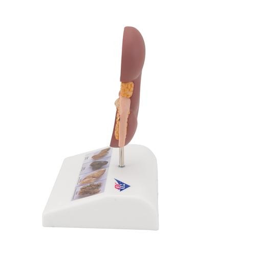 3B Scientific Kidney Stone Anatomy Model | Anatomy Warehouse