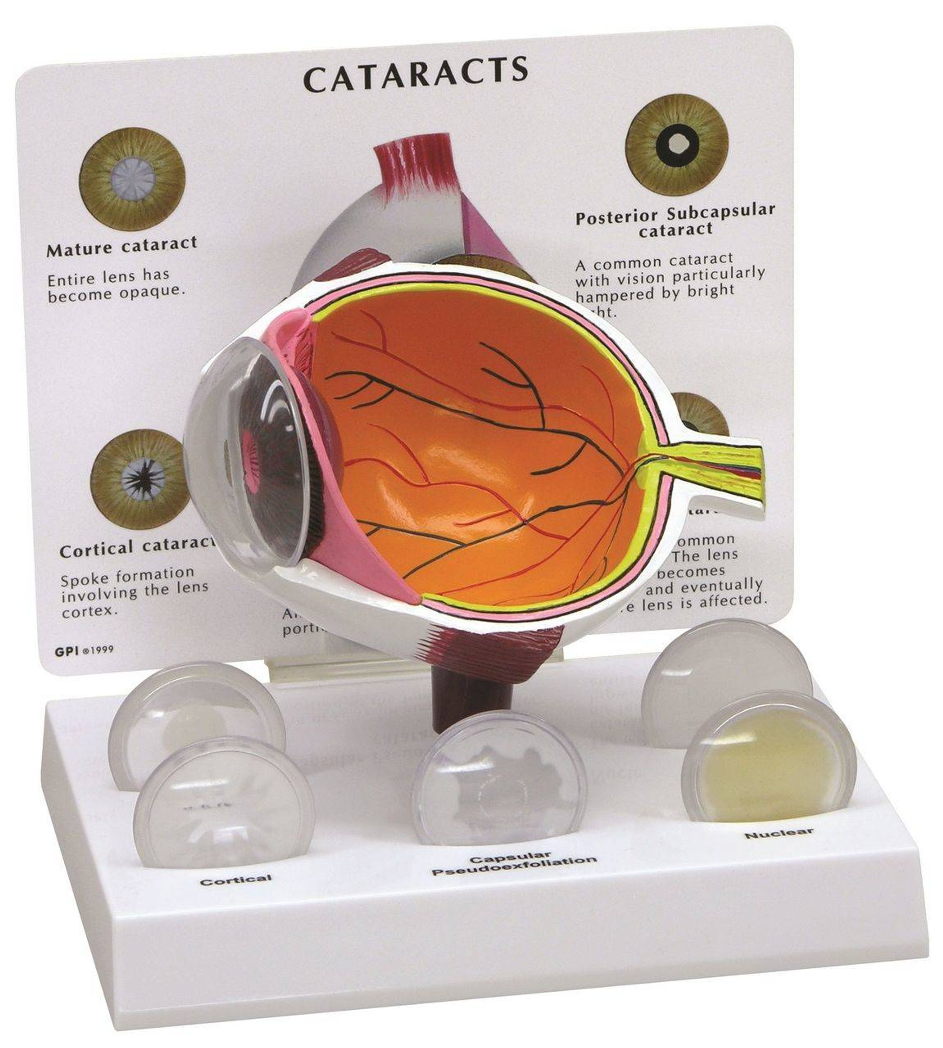GPI Anatomicals Cataract Eye Anatomy Model | Anatomy Warehouse