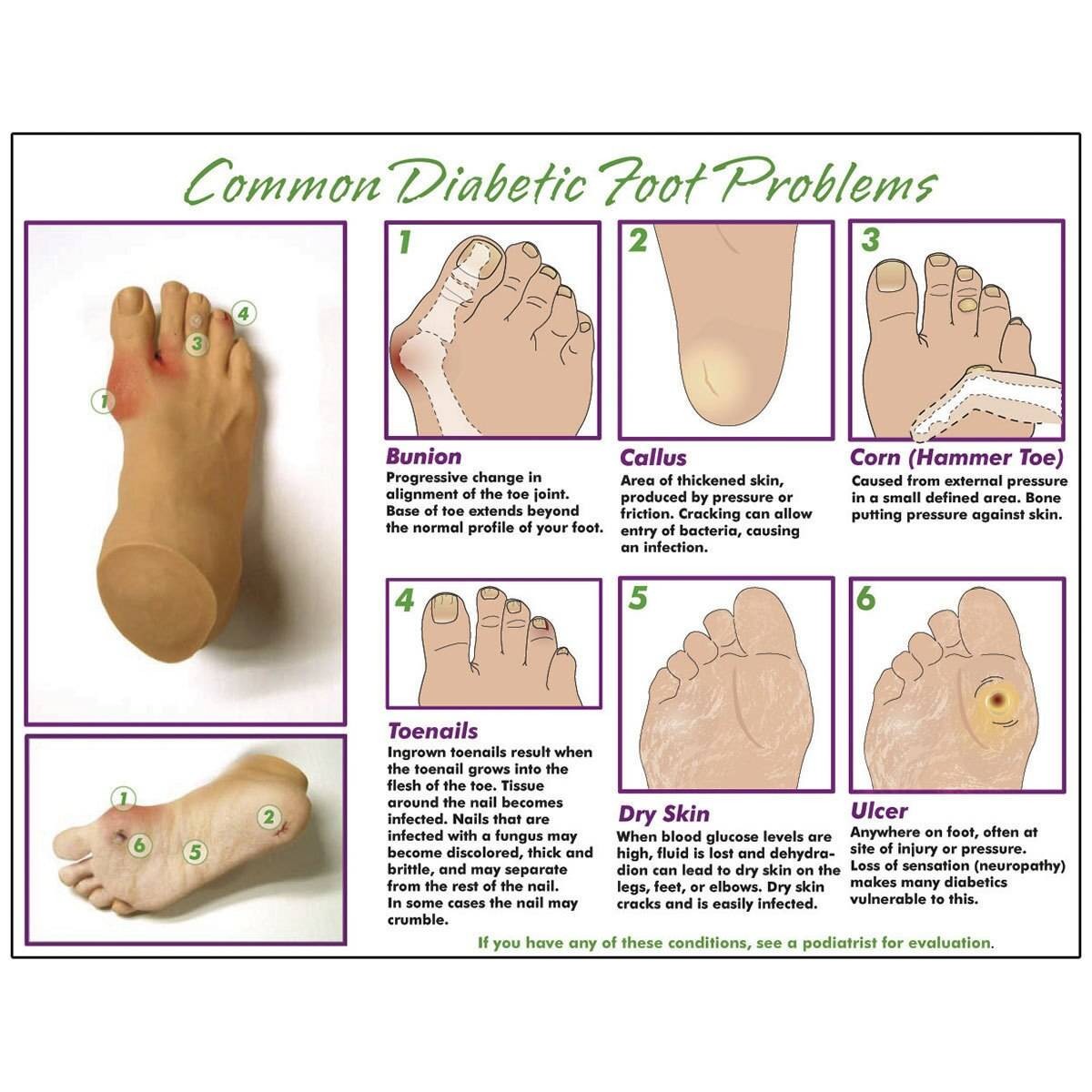 Nasco Healthcare Common Foot Problems Display | Anatomy Warehouse
