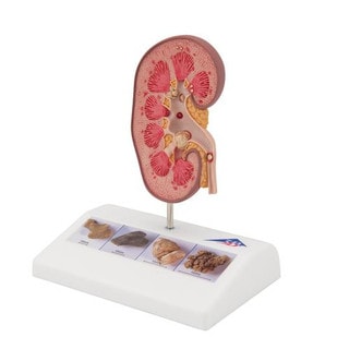 3B Scientific Kidney Stone Anatomy Model | Anatomy Warehouse