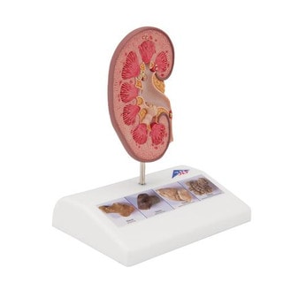 3B Scientific Kidney Stone Anatomy Model | Anatomy Warehouse
