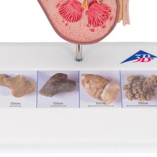 3B Scientific Kidney Stone Anatomy Model | Anatomy Warehouse